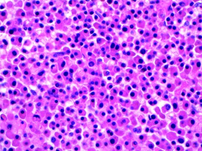 Multiple Myeloma: An Overview of Symptoms, Causes, Diagnosis and ...