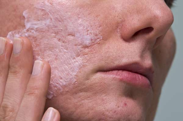 Clear Acne Scars Fast & Simple with the Best Methods ...