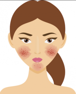 7 Reasons Why Your Face Keeps Breaking Out | ReliableRxPharmacy Blog ...