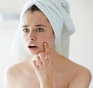 How to Get Rid of Summer Acne? | ReliableRxPharmacy Blog, Health Blog