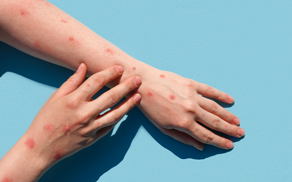 What is Monkeypox, its symptoms, and what threat to you ...