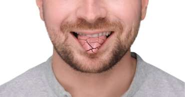 The Role of Pilomax 5 mg in Treating Dry Mouth: Dosage and Precautions ...
