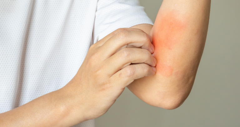 Prevent Dry Skin and Eczema This Winter
